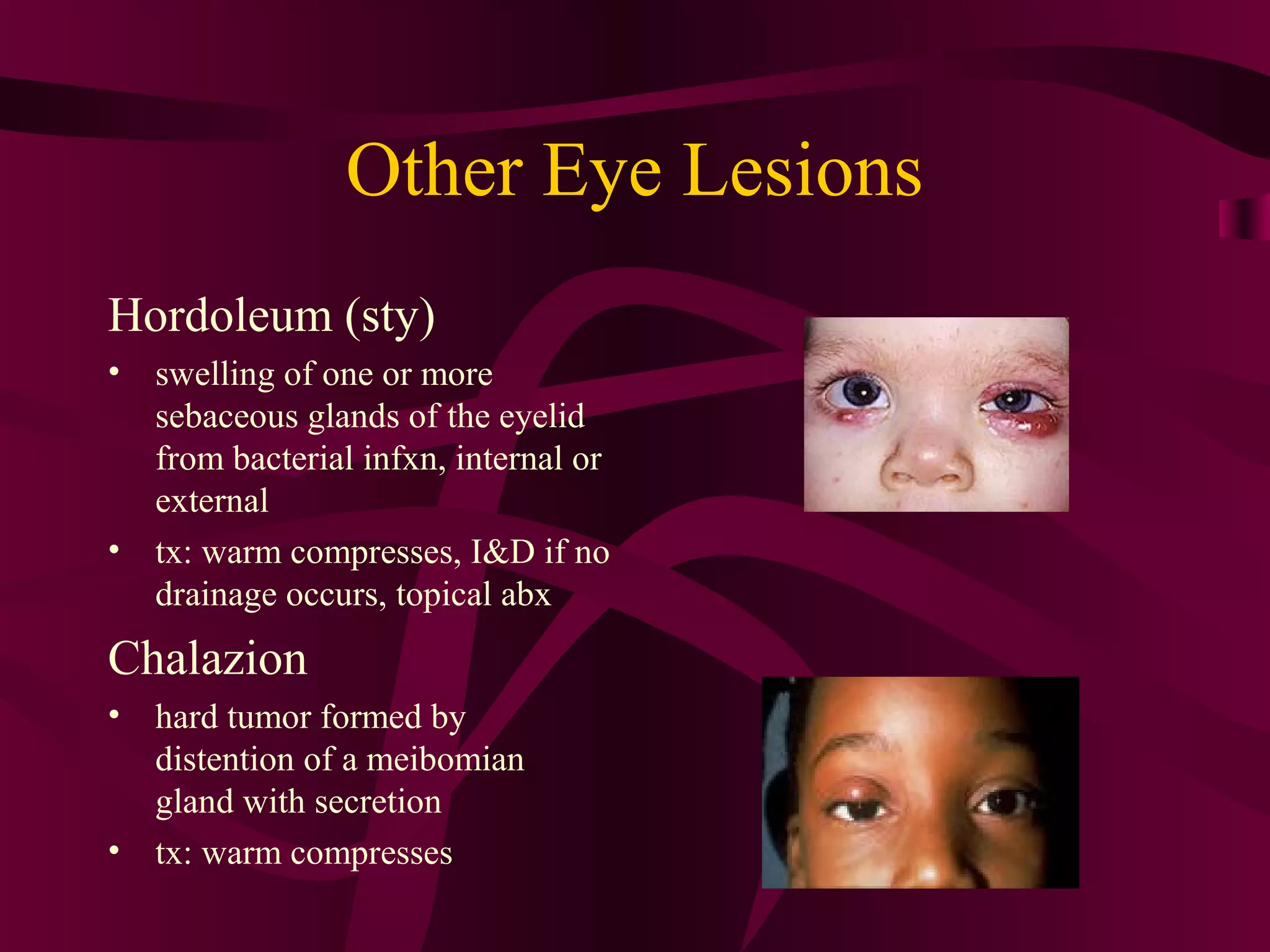 Conjunctivitis | PPT