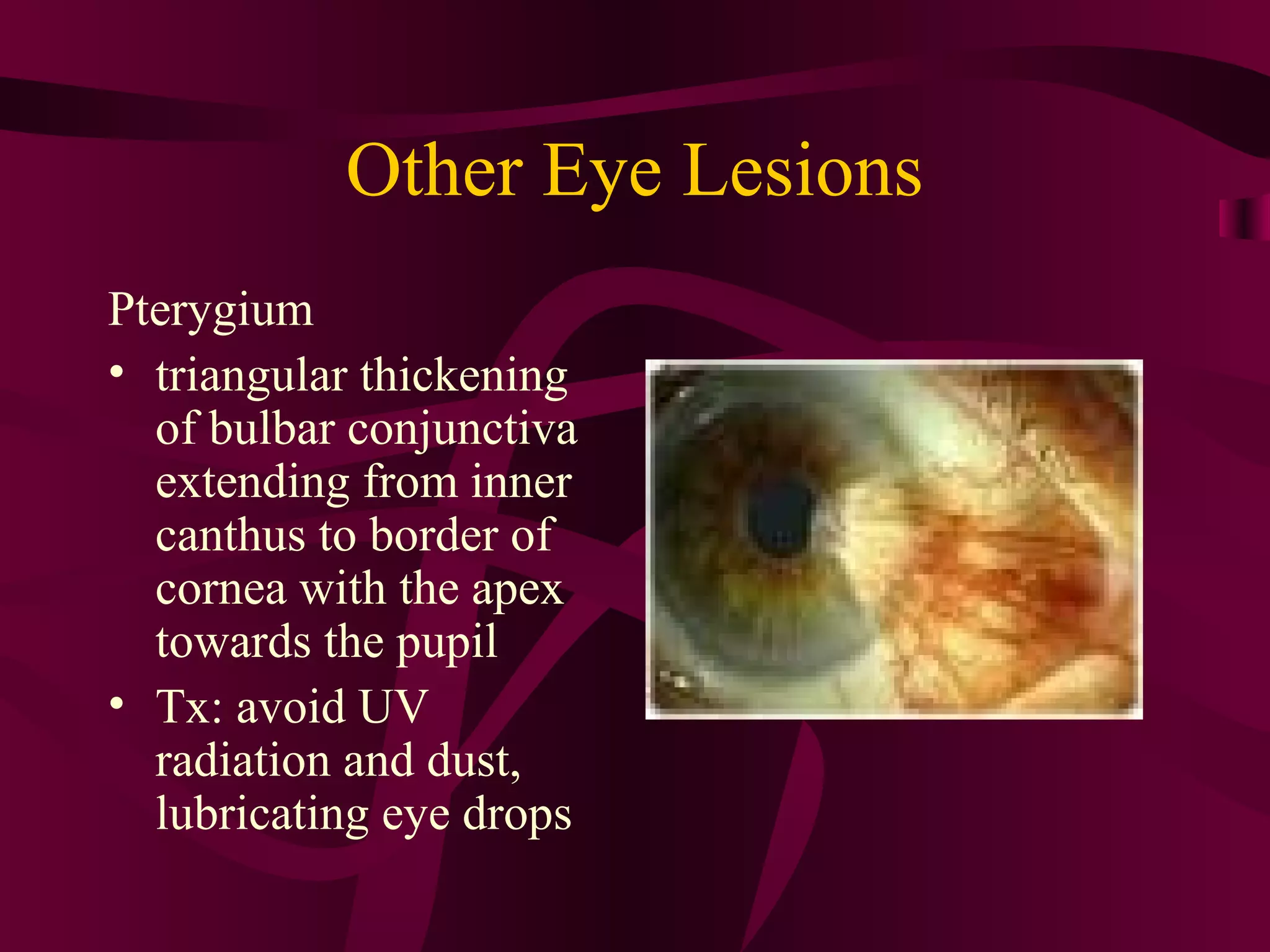 Conjunctivitis | PPT