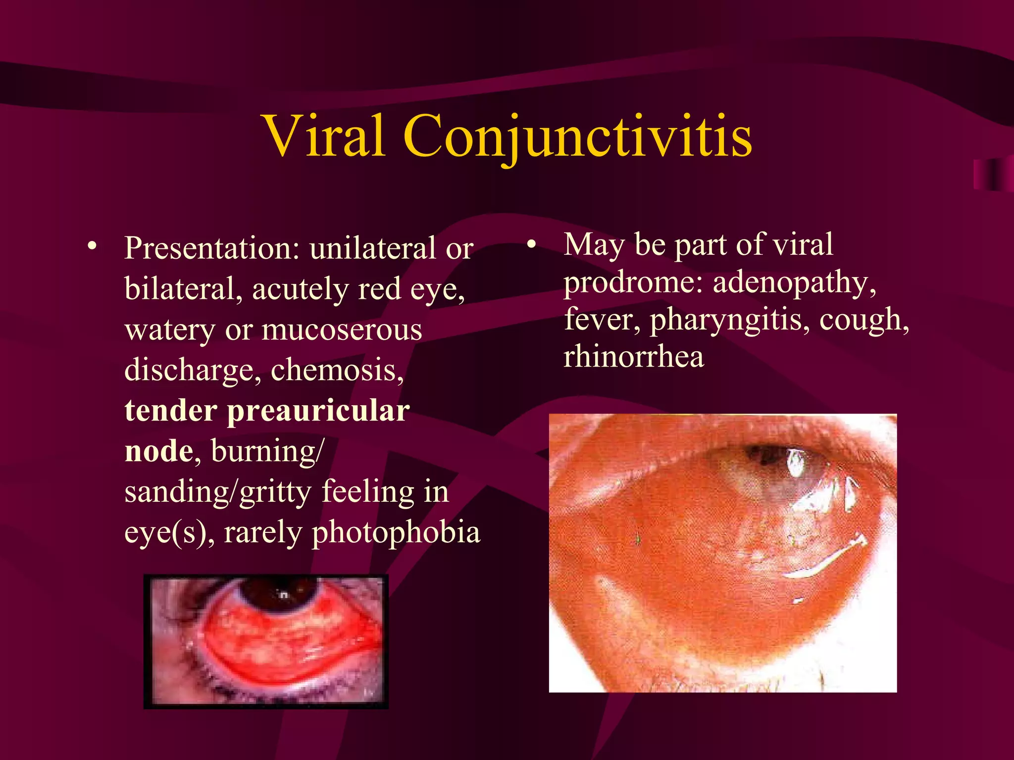 Conjunctivitis | PPT