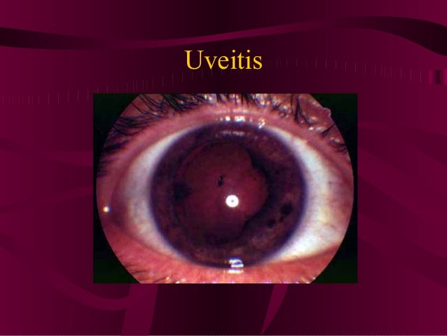 Uveitis Vs Conjunctivitis