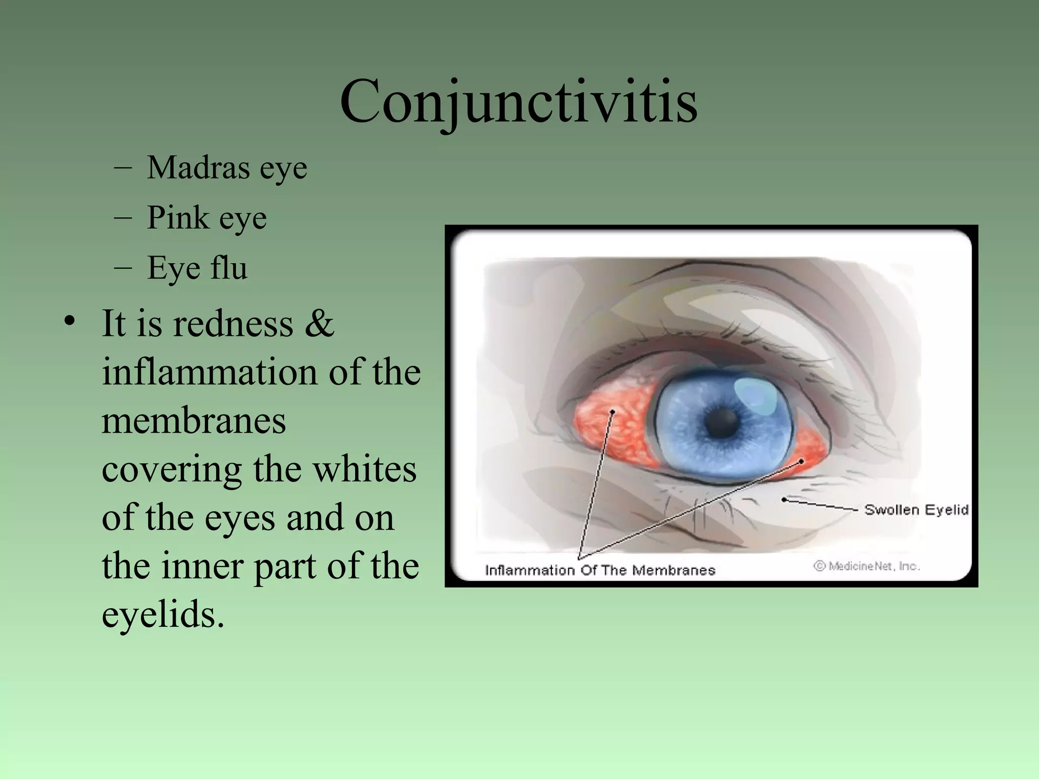 Conjunctivitis | PPS