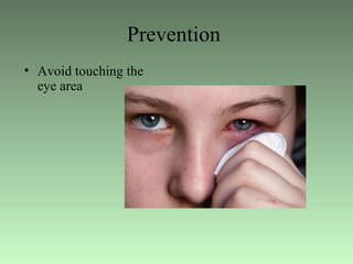 Conjunctivitis | PPS