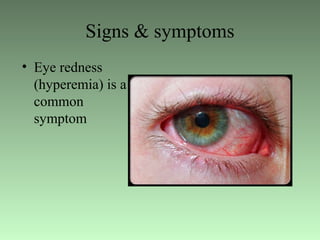 Conjunctivitis | PPS
