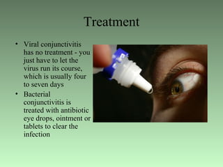 Conjunctivitis | PPT