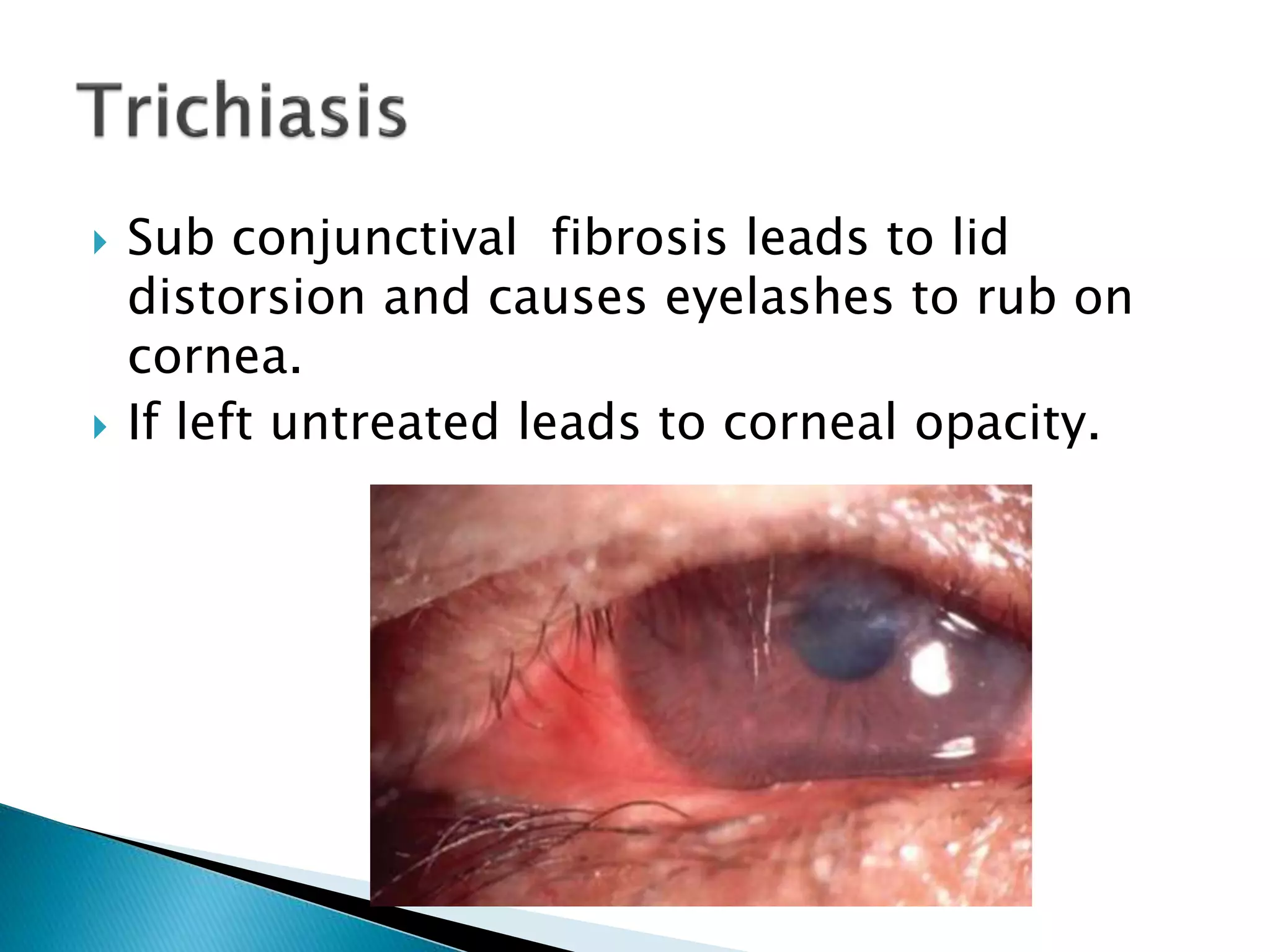 Conjunctivitis | PPTX