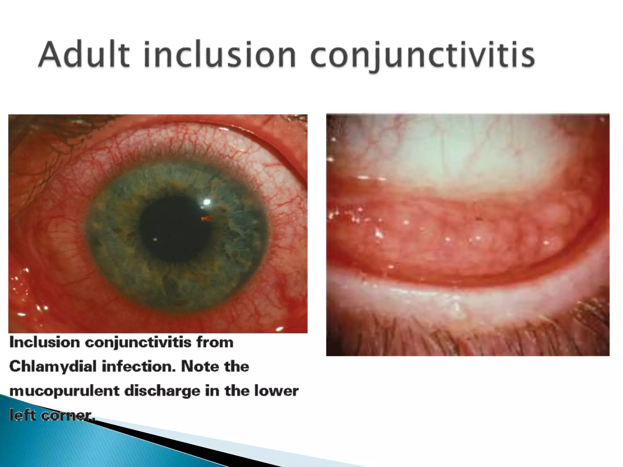 Conjunctivitis | PPTX