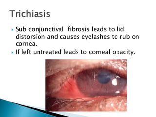 Conjunctivitis | PPT
