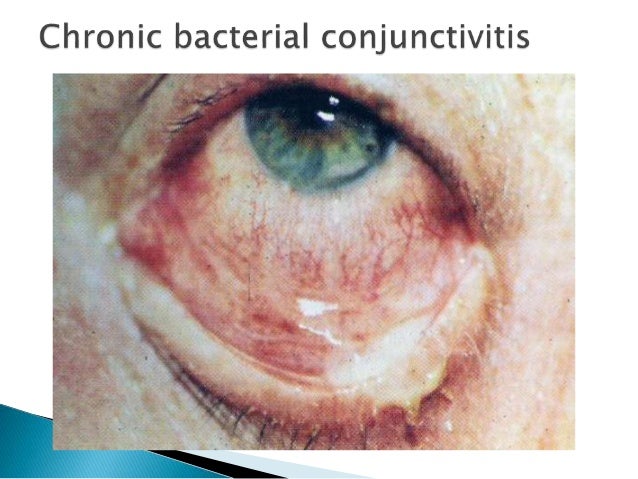 Conjunctivitis