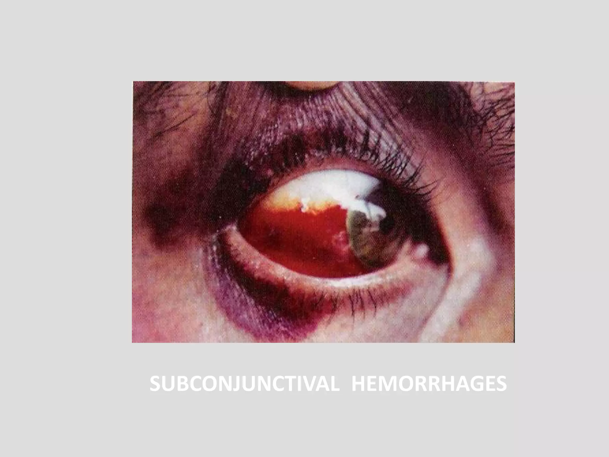 Conjunctivitis | PPTX