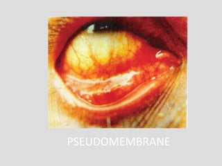 Conjunctivitis | PPTX