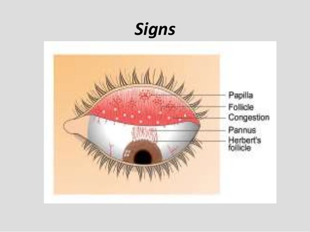Follicular Vs Papillary Conjunctivitis