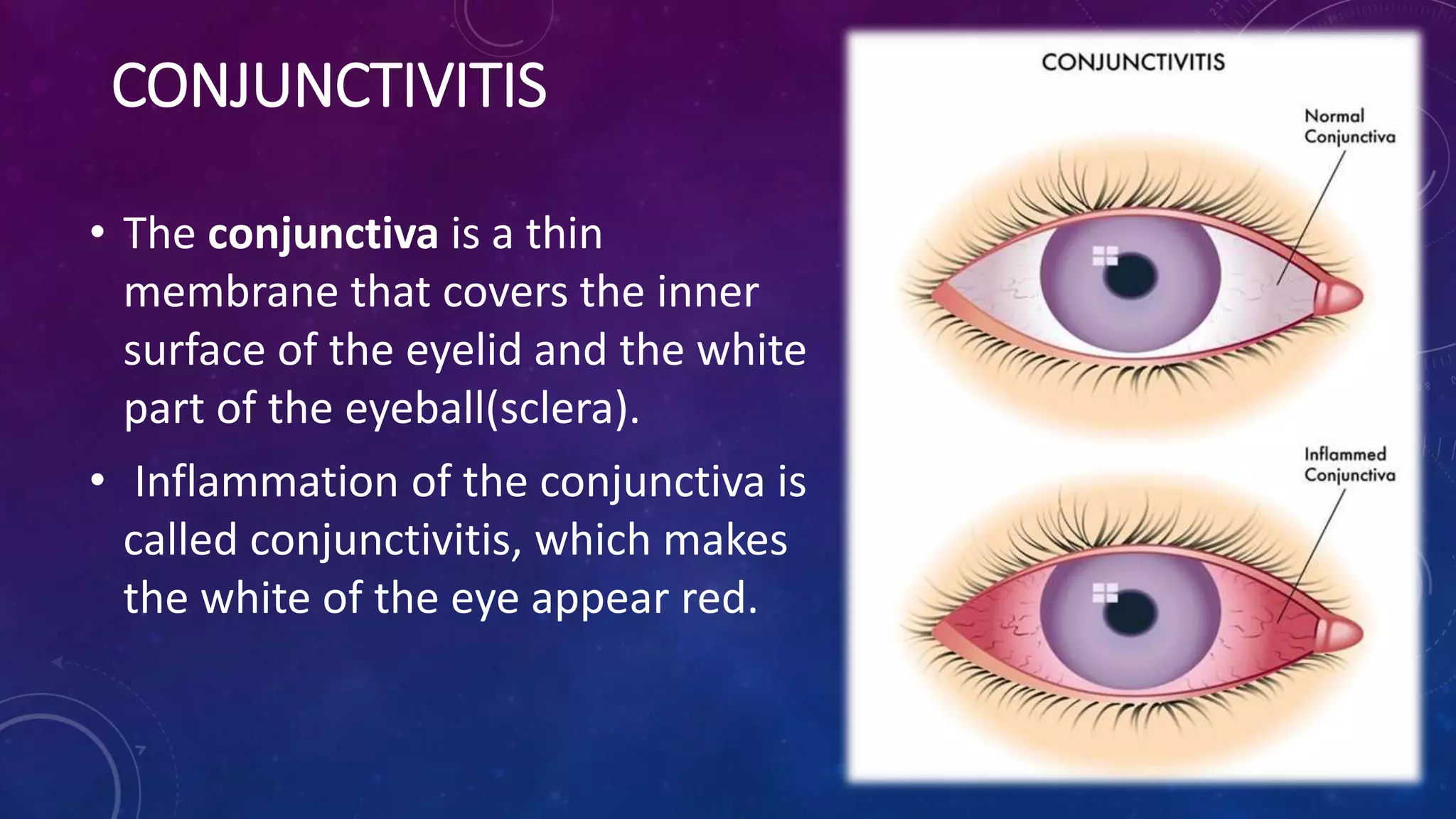 Conjunctivitis | PPTX