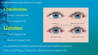 Conjunctivitis | PPTX