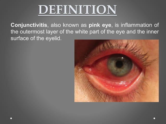 Conjunctivitis for Nurses- Easy Explanation | PDF | Eye and Vision ...