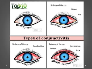 Conjunctivitis for Nurses- Easy Explanation | PDF