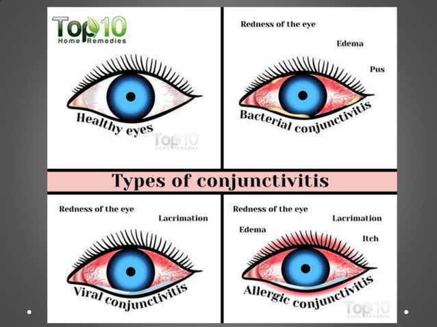 Conjunctivitis for Nurses- Easy Explanation | PDF | Eye and Vision ...