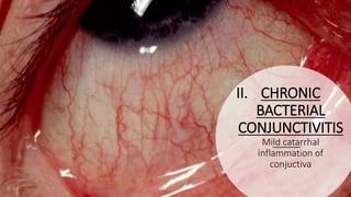 Conjunctivitis | PPTX