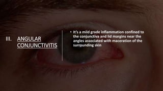 Conjunctivitis | PPTX