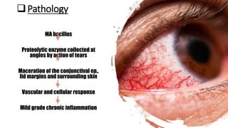 Conjunctivitis | PPTX