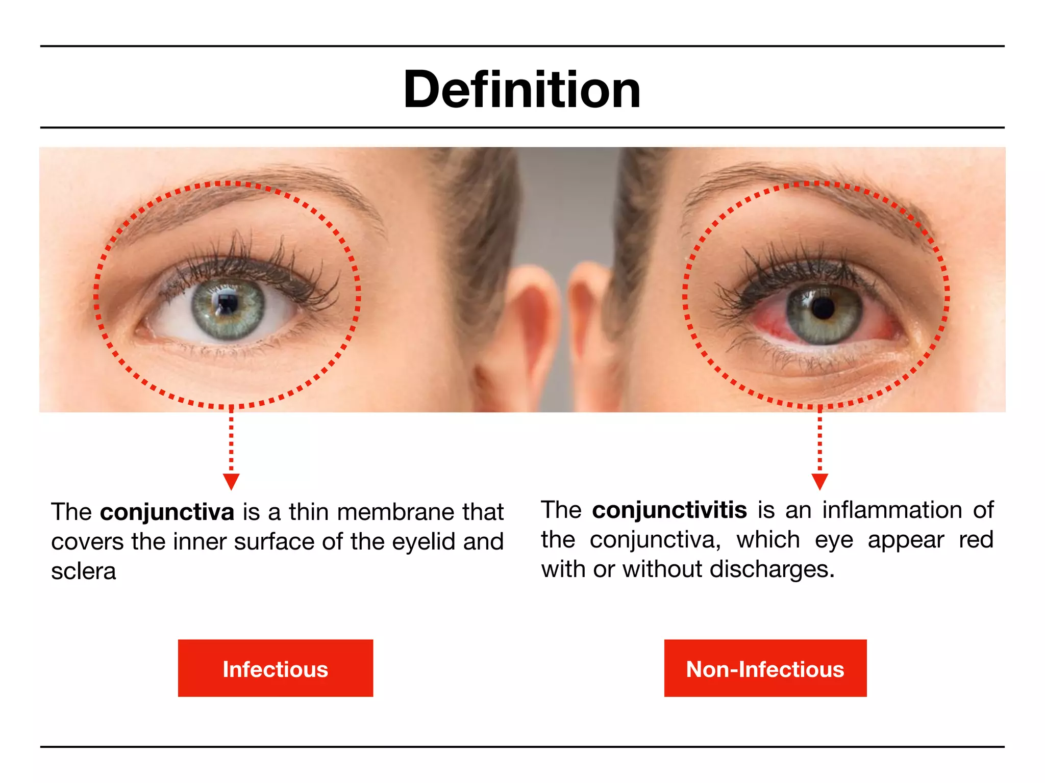 Conjunctivitis | PDF