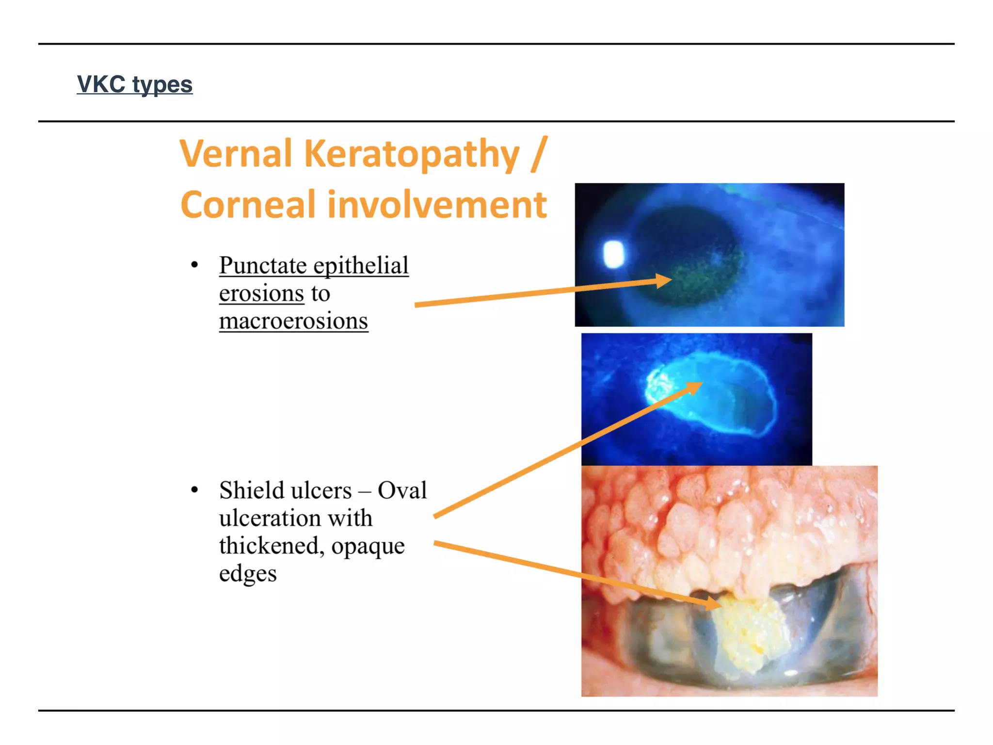 Conjunctivitis | PDF