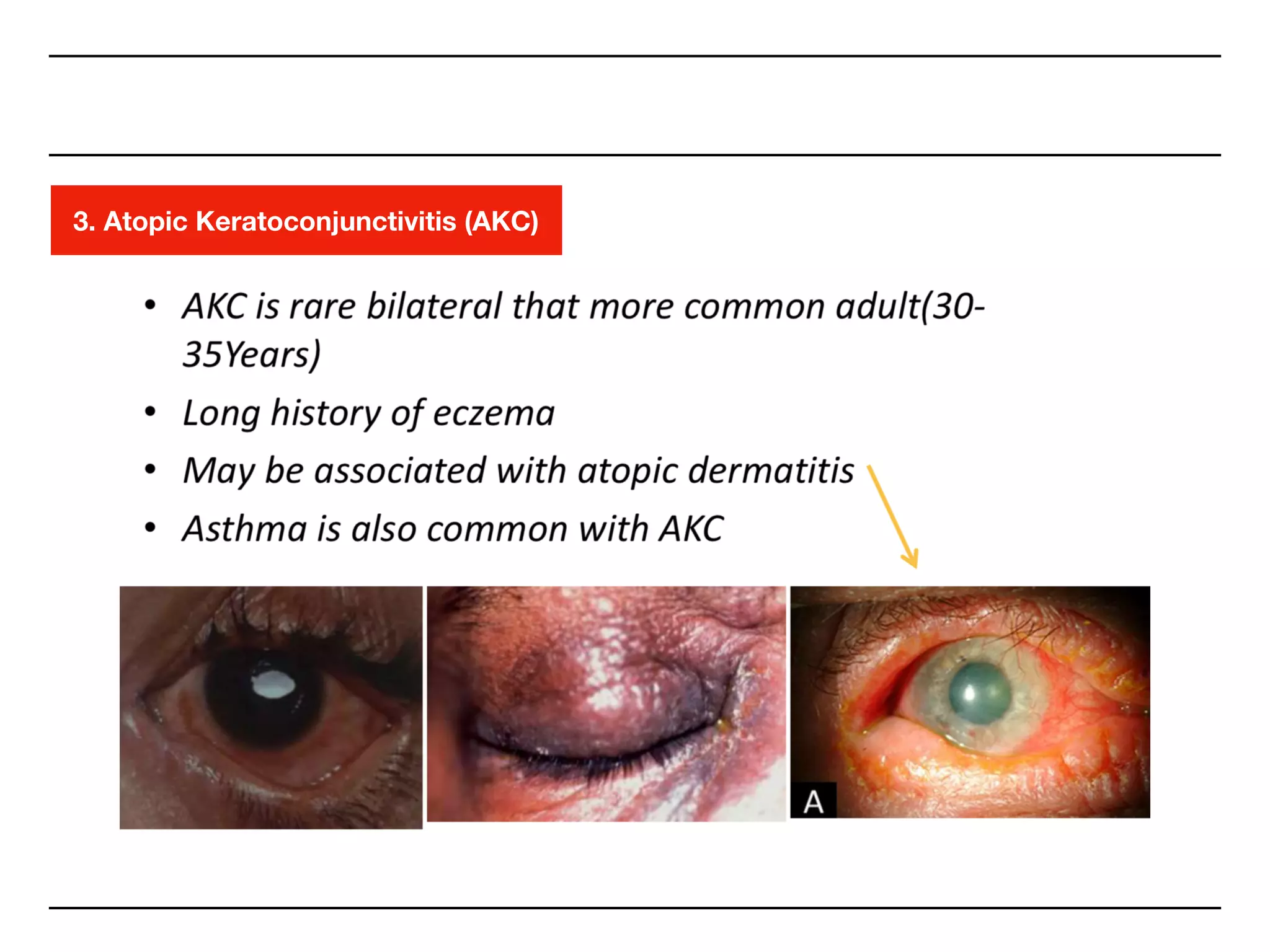 Conjunctivitis | PDF