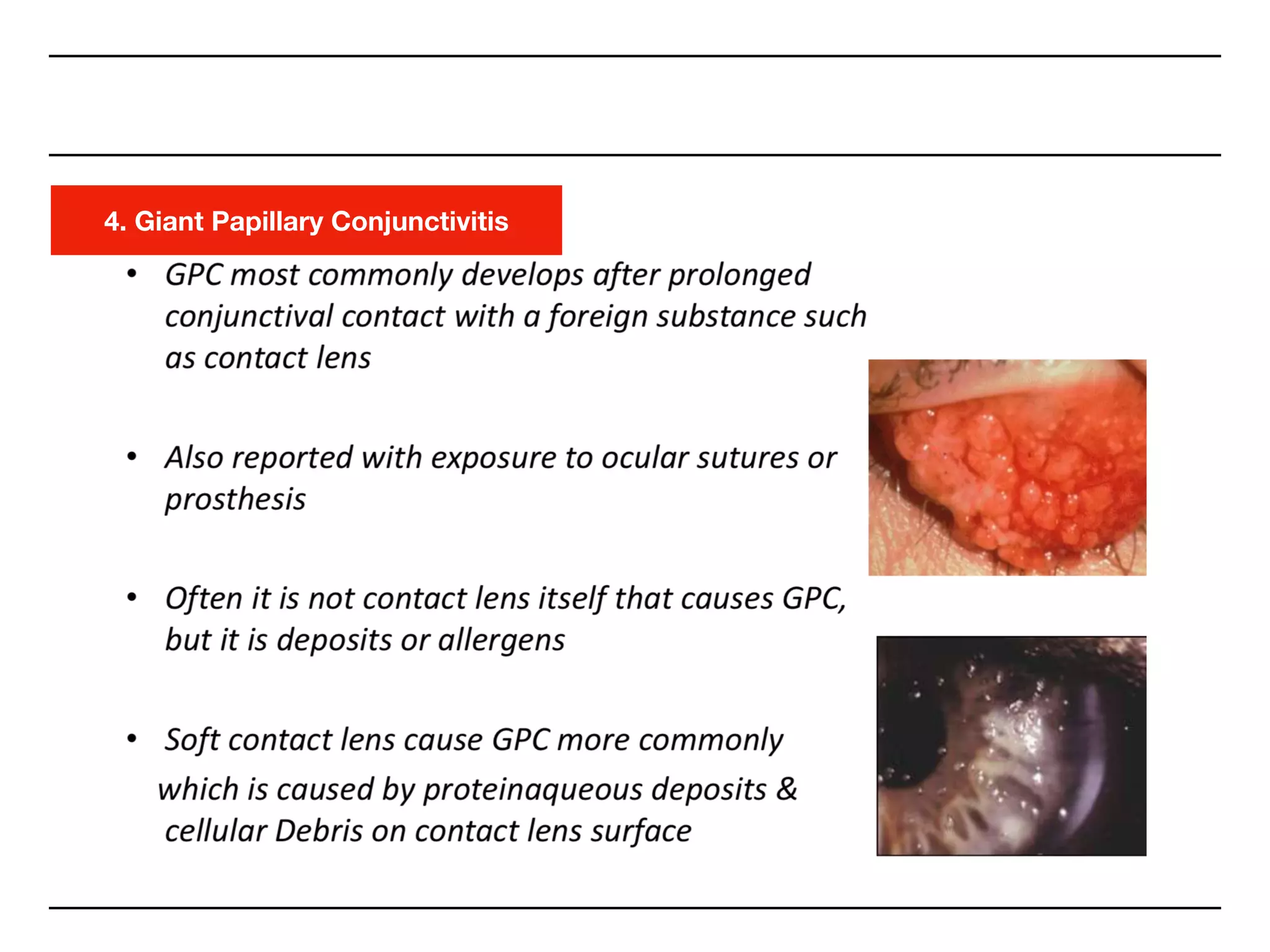 Conjunctivitis | PDF