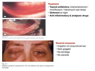 Conjunctivitis | PDF