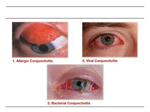 Conjunctivitis | PDF | Eye and Vision Conditions | Diseases and Conditions