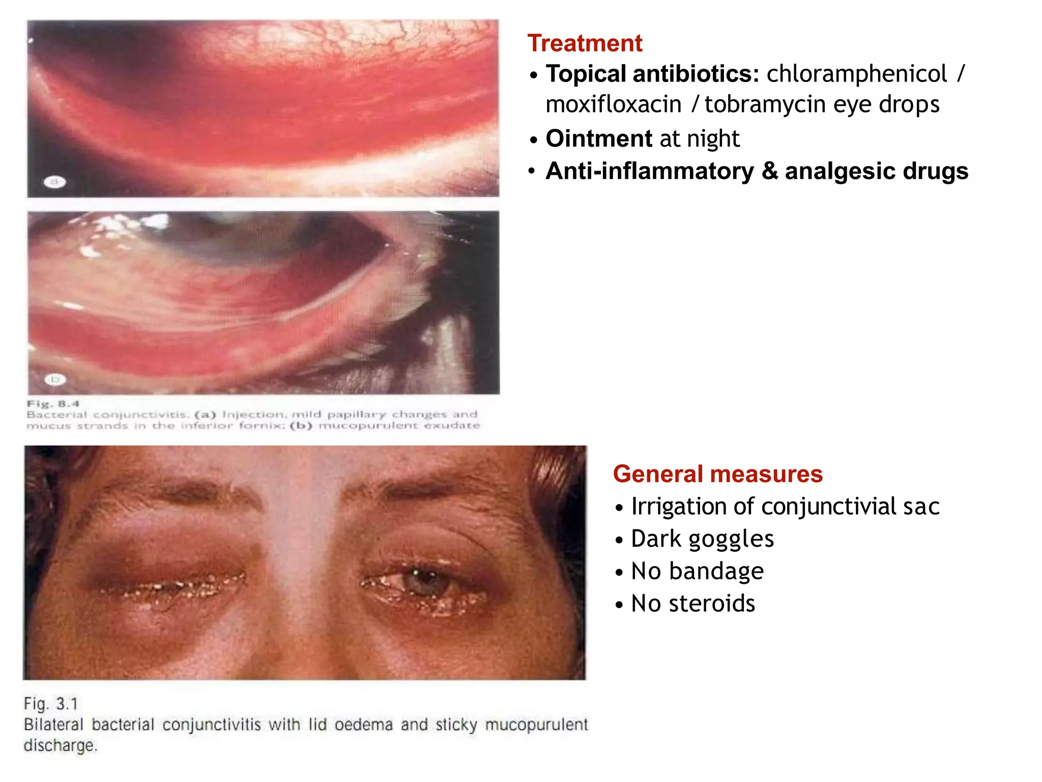 conjunctivitis-200105121616 (1).pptx
