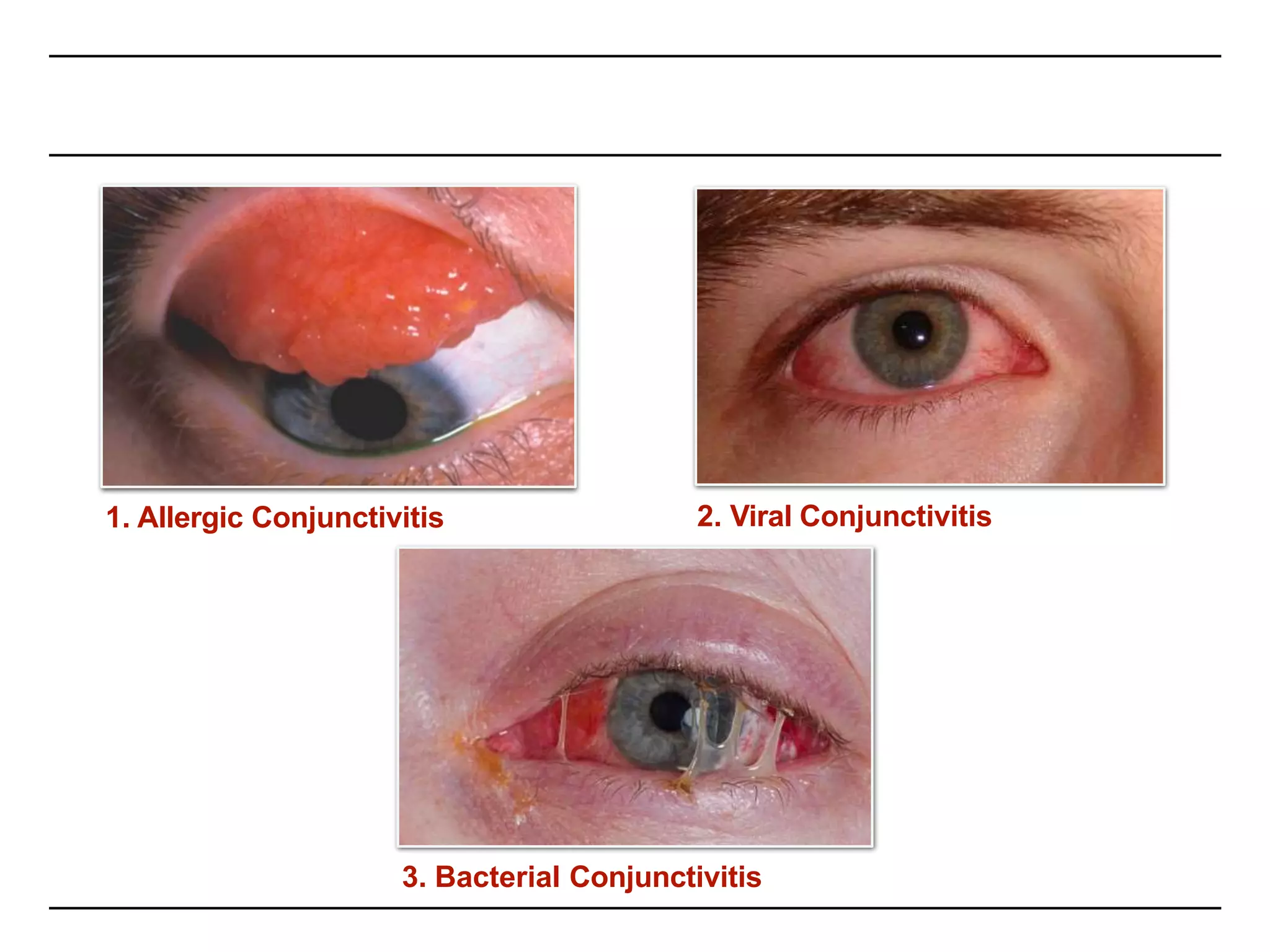 conjunctivitis-200105121616 (1).pptx