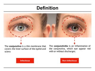 conjunctivitis-200105121616 (1).pptx