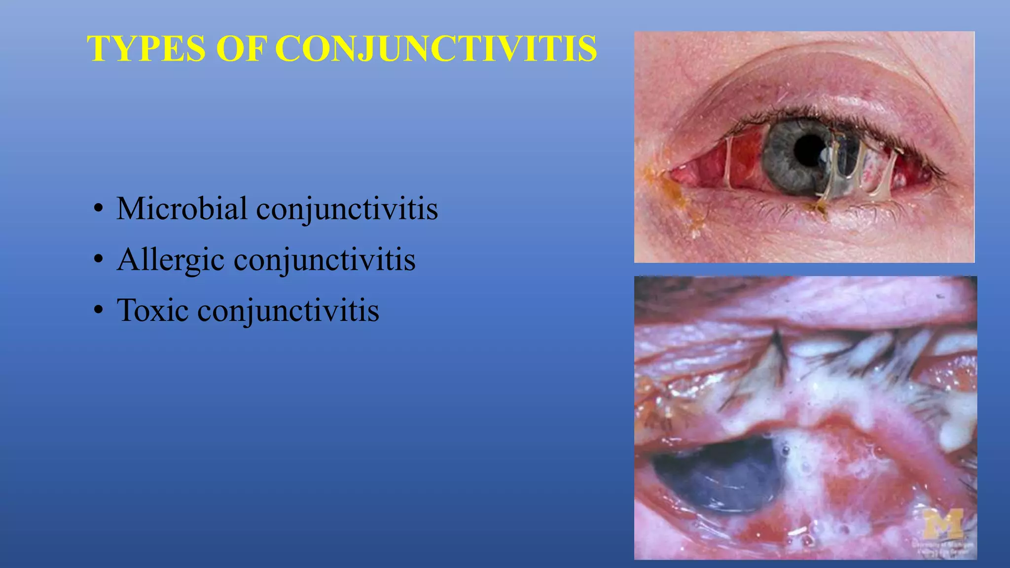 Conjunctivitis | PPTX