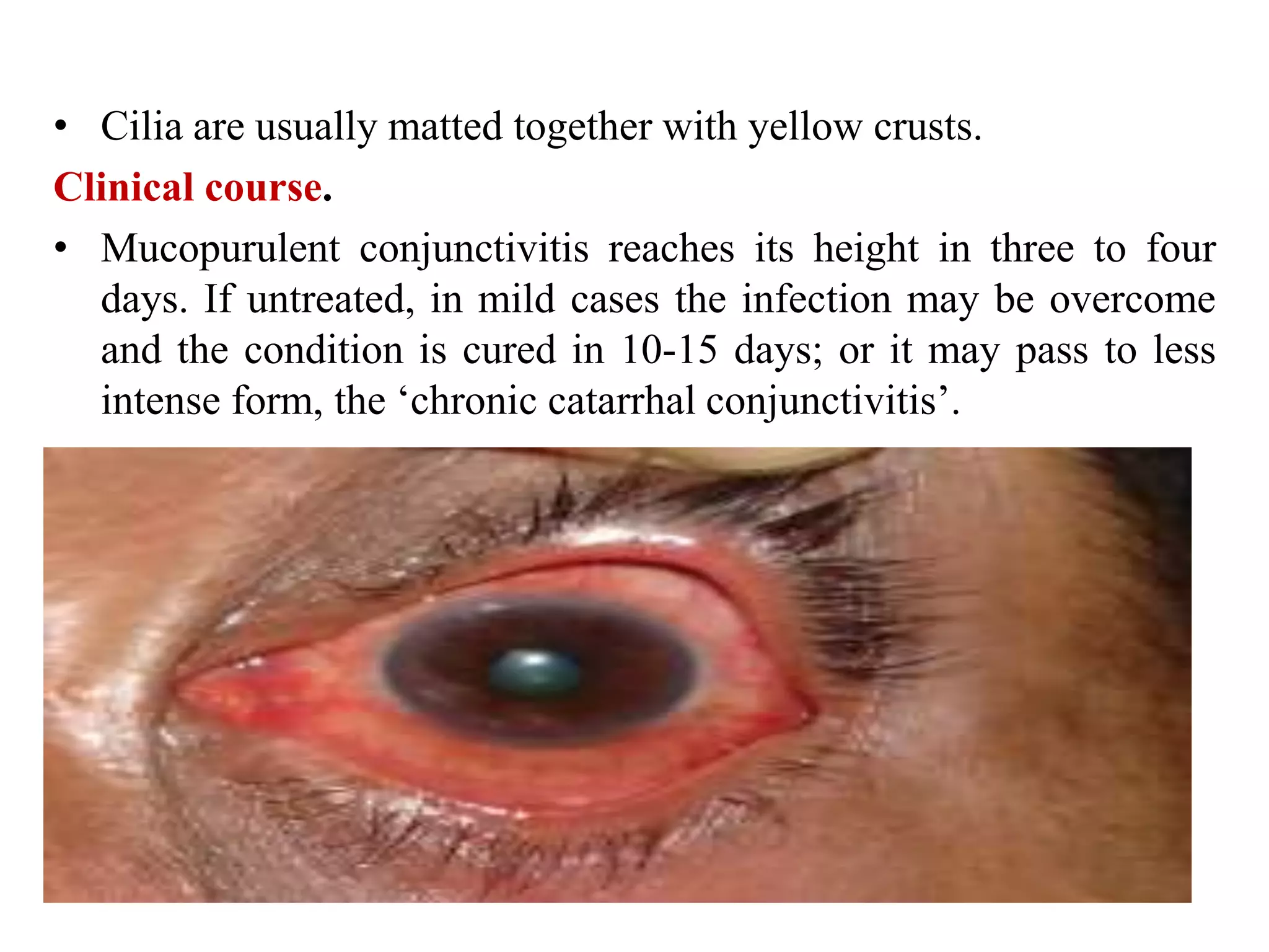 Conjunctivitis | PPTX