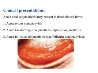 Conjunctivitis | PPTX