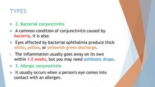 Conjunctivitis | PDF