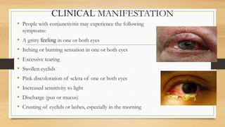 conjunctivitis.pptx | Eye and Vision Conditions | Diseases and Conditions