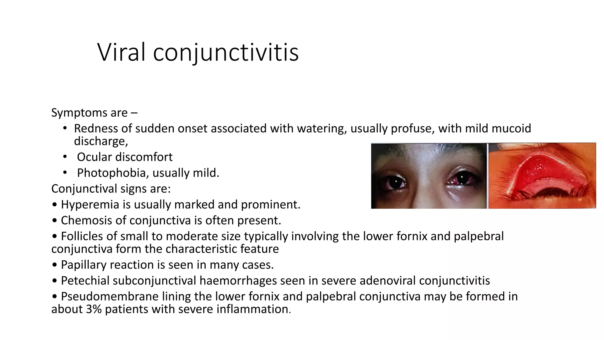 conjunctivitis.pptx