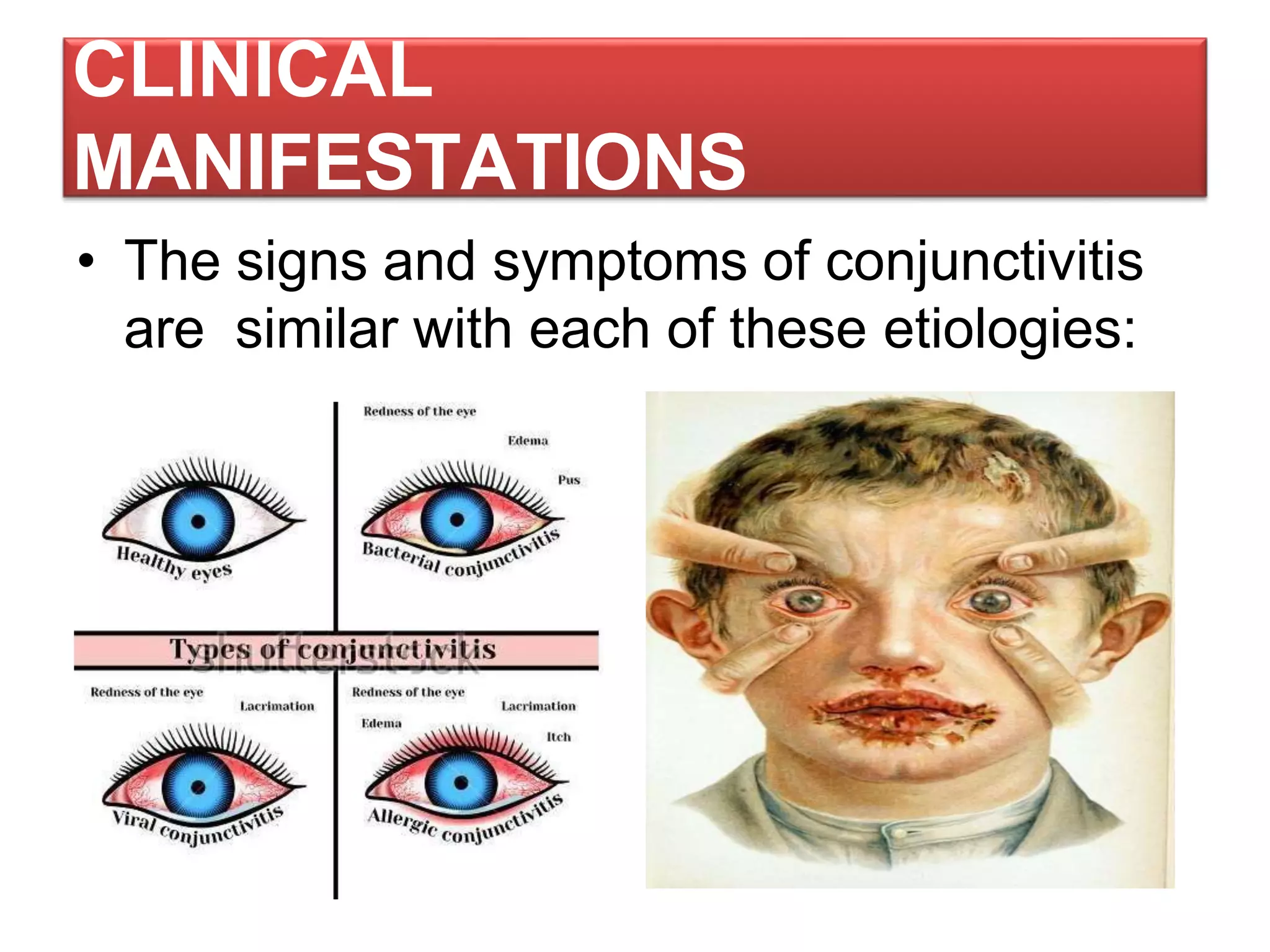 Conjunctivitis.pptx