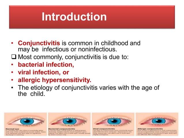 Bacterial vs Viral Conjunctivitis: Signs, Symptoms and Treatment | PPT