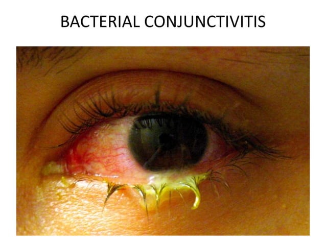 conjunctivitis.ppt | Allergies | Diseases and Conditions