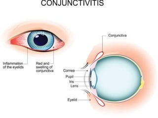 conjunctivitis.pptx.conjunctivitis.eye.. | PPT