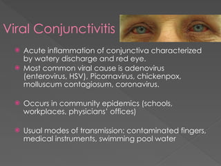 Conjunctivitis.pptx . . . . . . . . . . . . | PPT