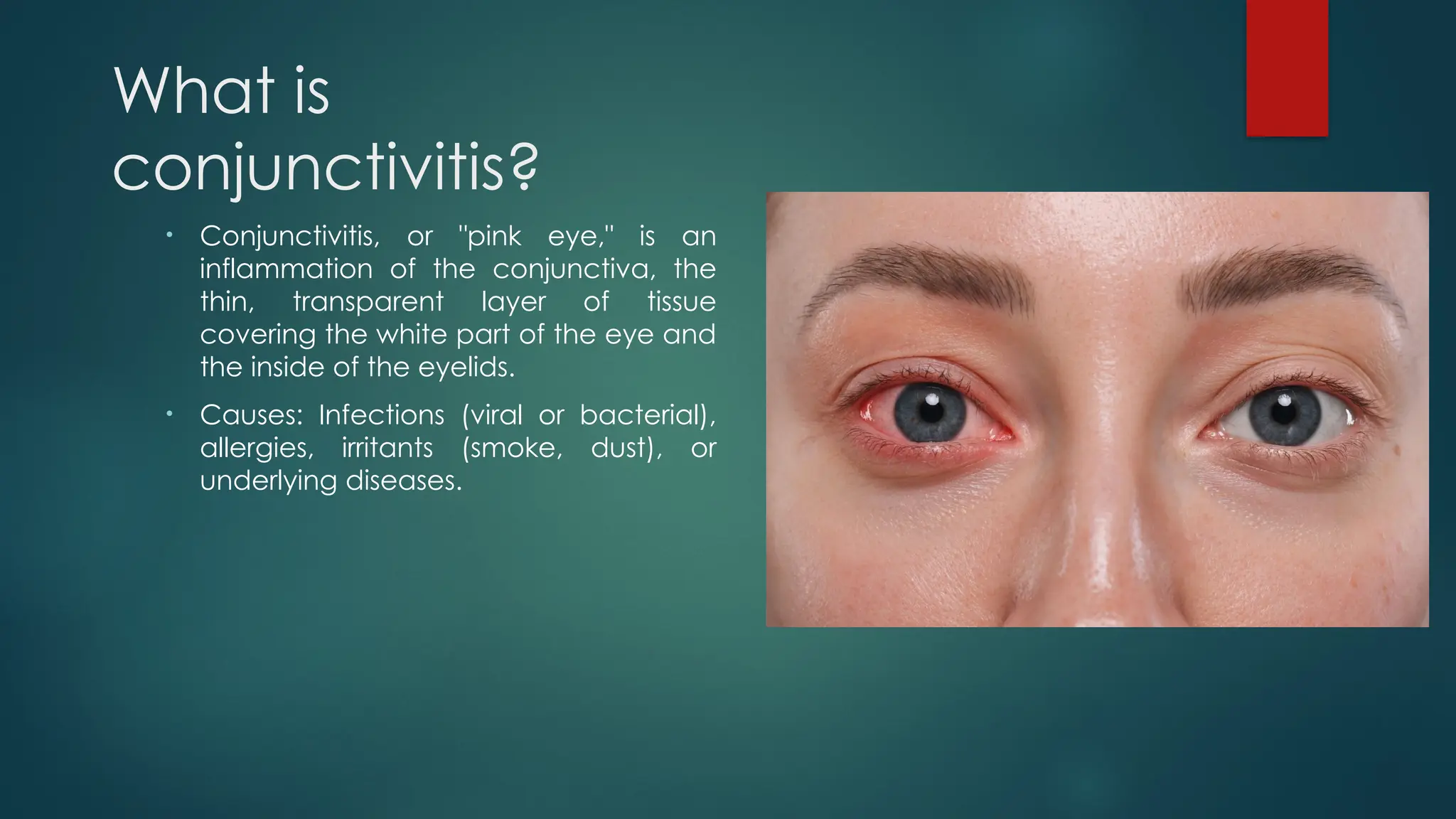 Conjunctivitis powerpoint. Short and conceise | PPTX