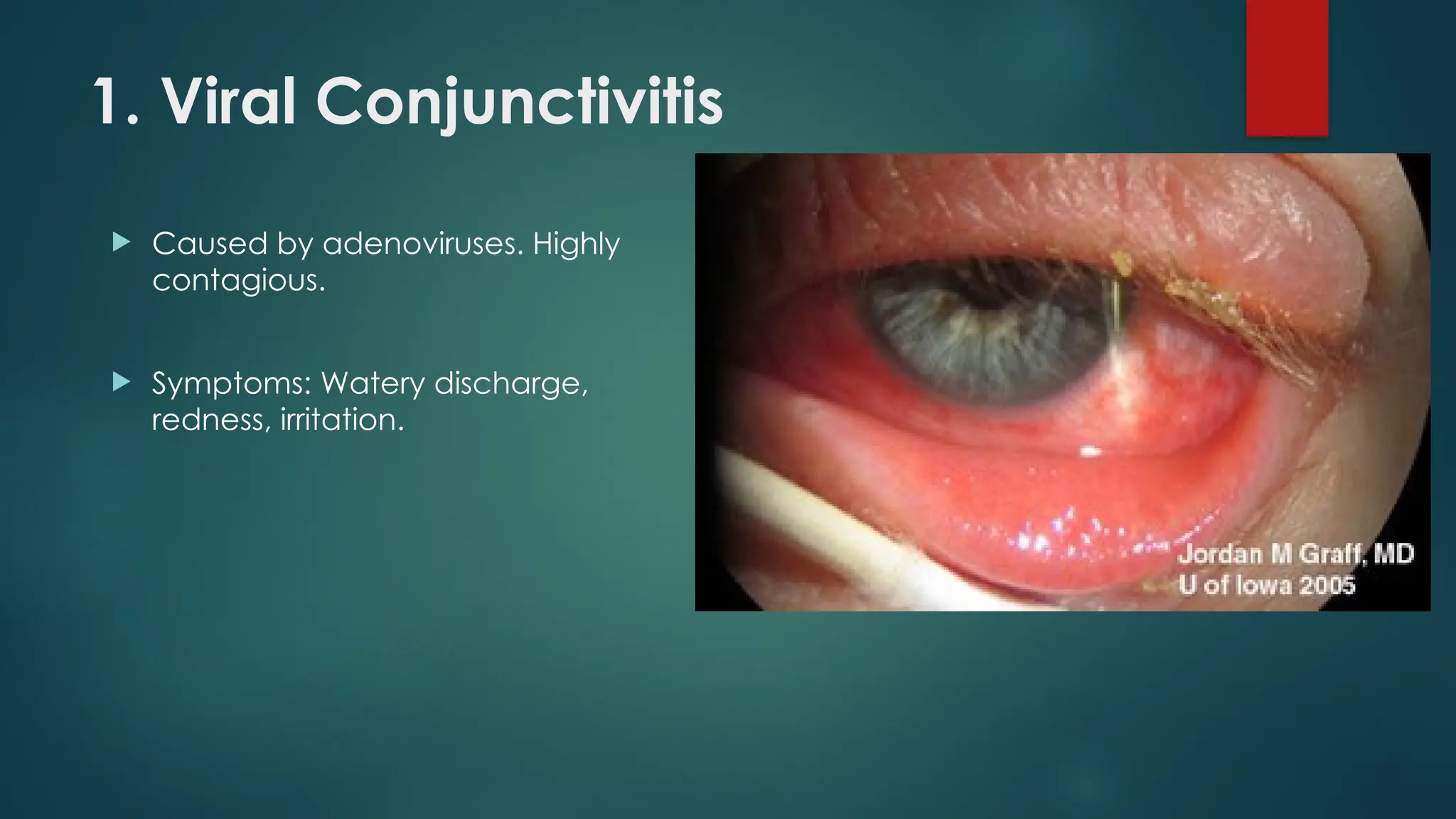 Conjunctivitis powerpoint. Short and conceise | PPTX