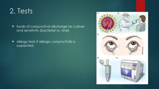 Conjunctivitis powerpoint. Short and conceise | PPTX