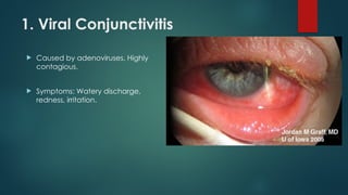 Conjunctivitis powerpoint. Short and conceise | PPTX
