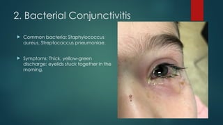 Conjunctivitis powerpoint. Short and conceise | PPTX