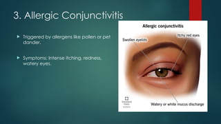 Conjunctivitis powerpoint. Short and conceise | PPTX