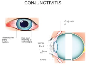 conjunctivitis seminar. Includes definition, etiology | PPTX